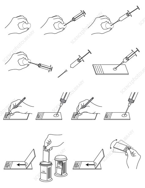 Fine Needle Aspiration Illustration Stock Image C0611900