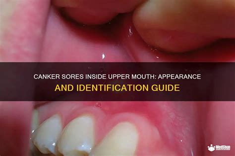 Canker Sores Inside Upper Mouth Appearance And Identification Guide