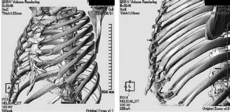Xiphoid Process Protrusion Sternum Anatomy And Labeled Diagram