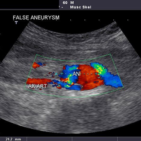 Ultrasound Of The Left Axillary Artery Pseudoaneurysm Download