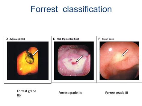Bleeding Duodenal Ulcer Pptx