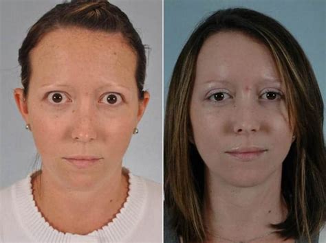 Hypothyroidism Before And After Face