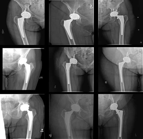 Nine Different Designs Of Commonly Used Total Hip Replacement Thr