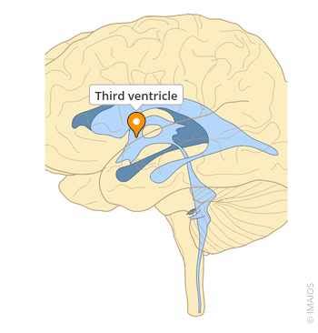 Third Ventricle E Anatomy Imaios