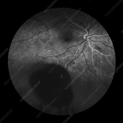 Choroidal Melanoma 2 Of 8 Stock Image C0306964 Science Photo Library