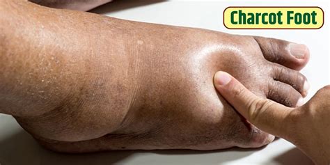 How Physical Therapy Can Benefit Charcot Foot Treatment Pune Foot Ankle