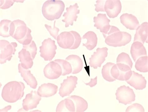 Fragmented Red Blood Cell Or Schistocyte Medical Laboratories