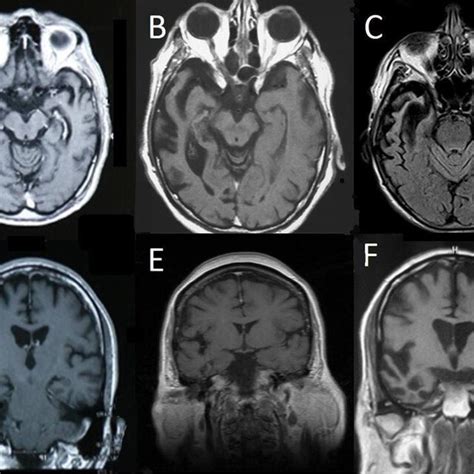 Representative Magnetic Resonance Imaging Mri Scans Of 6 Patients