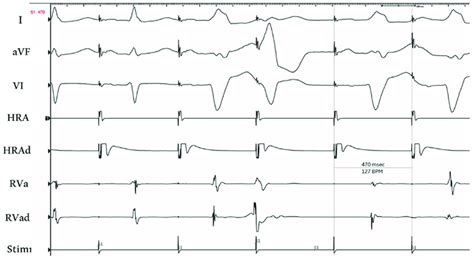 Intracardiac Electrogram Showing Initiation Of Left Bundle Branch Block Download Scientific