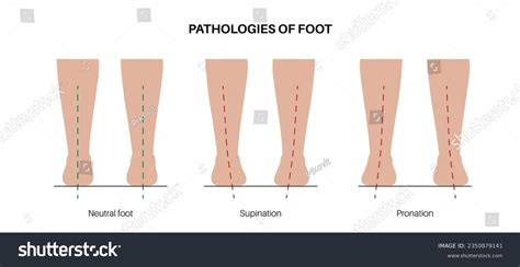 Foot Pronation