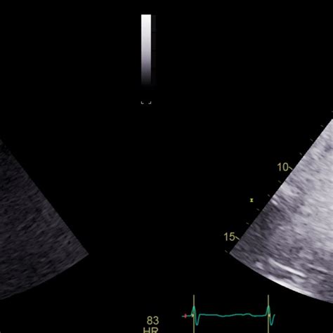 The Lesion Consists Of Highly Pleomorphic Large Tumor Cells With