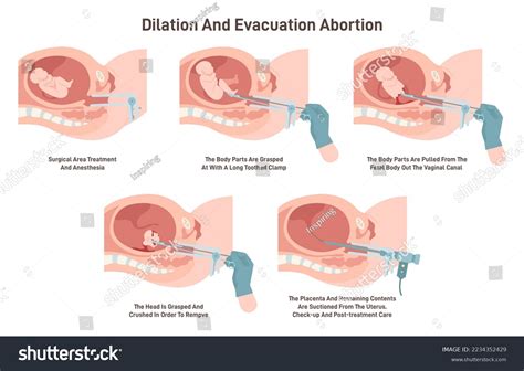 Dilation And Evacuation