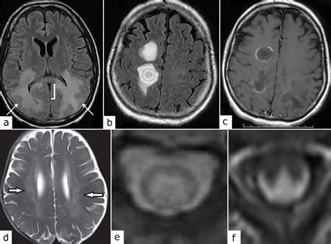Mri Signs Of Cns Demyelinating Diseases Multiple Sclerosis And