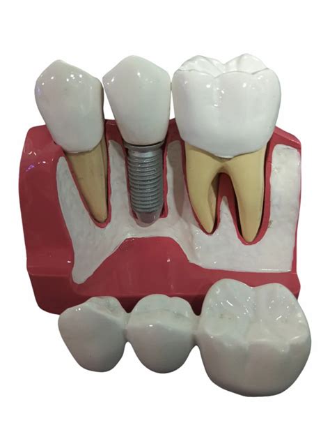 Three Tooth Implant Model For Clinical Material Acrylic At ₹ 1200