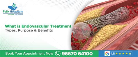 What Is Endovascular Treatment In Noida Types Purpose And Benefits