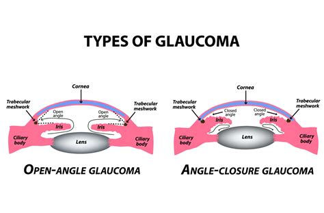 Primary Open Angle Glaucoma Pathophysiology At Viola Lynch Blog