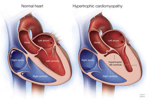 Some Of The Clinical Causes For Sudden Cardiac Arrest Sca Heartbeat Of Champions Foundation