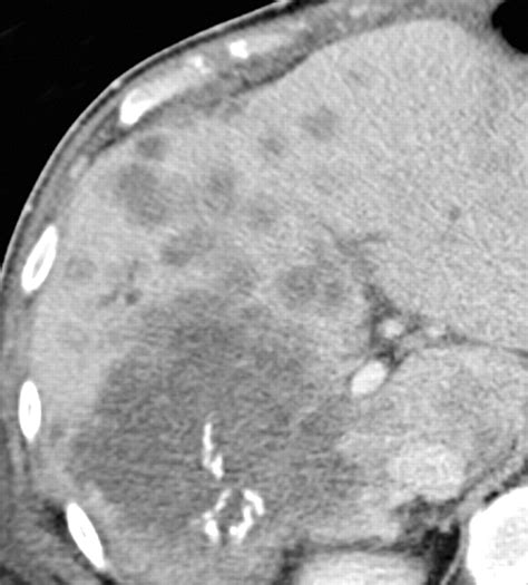 Recurrent Pyogenic Cholangitis From Imaging To Intervention Ajr