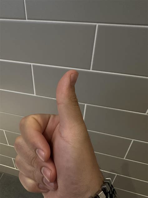 Does This Look Like Cellulitis Rbugbites