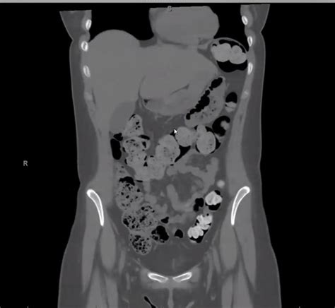 My Ct Scan Of Severe Constipation Rconstipation