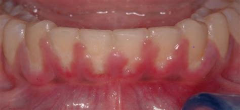 Localized Diffuse Gingivitis فرهنگ تفصیلی دندانپزشکی