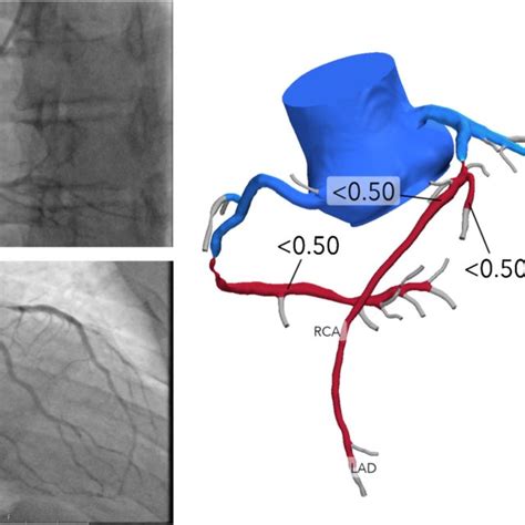 Case Example Of A 45 Year Old Gentleman With Severe Stenosis In The Lad