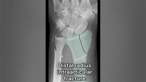 Distal Radius Intraarticular Fracture Youtube
