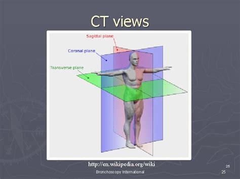 10 Planning Ebustbna Of Subcarinal Lymph Node Station