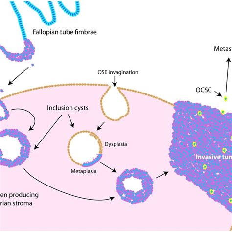 Schematic Illustrating Pathogenesis And Dedifferentiation In Epithelial