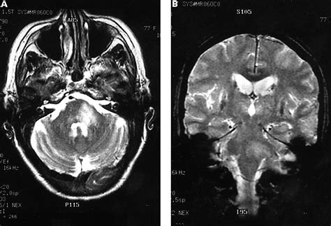Brainstem Encephalitis Fatal Subacute Cytomegalovirus Encephalitis