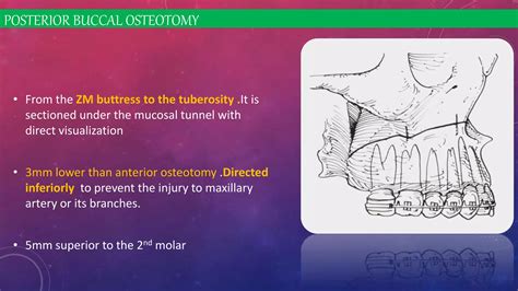 Maxillary Osteotomy Pptx