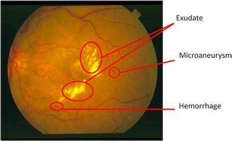 Retinal Fundus Image Of Dr Patient From Stare Dataset With Unhealthy Download Scientific