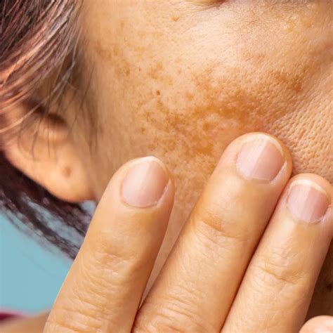 Melasma For Trumbull Westport And Derby Ct Adult And Pediatric