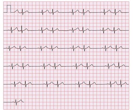 Pattern Before Afib R Readmyecg