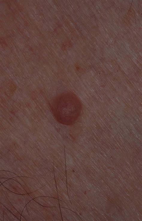 Neurofibroma Dermatology Advisor