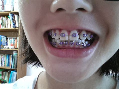 ♛geraldine Yan♛ My Braces Journey Part 1