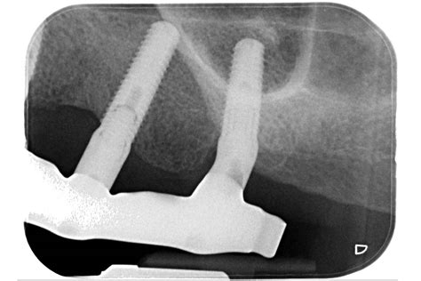 Full Maxillary Reconstruction With Maxgraft® Bonebuilder Dr C Hilscher Indication Matrix