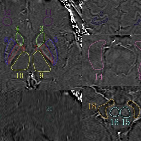 Rois Depicted On The Swi Phase Images 1 2 Parietal Cortex Pc 3
