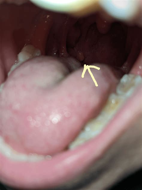 Tonsil Issues Found A Lump R Askdocs