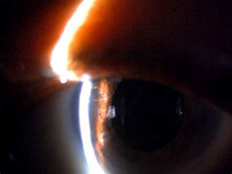 Moatez Billah Mekki On Linkedin Iol Iol Tilt Internal Astigmatism