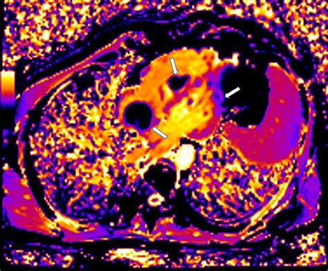 Four Chamber T1 Mapping Showing Lv Infiltration And Rv Right Atrium