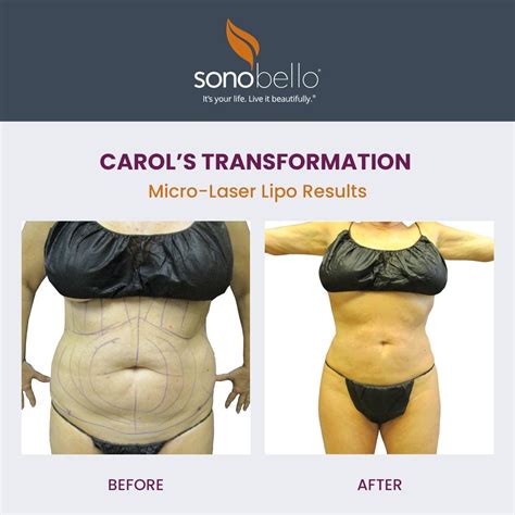 Sono Bello What An Awesome Before And After Full Core Transformation