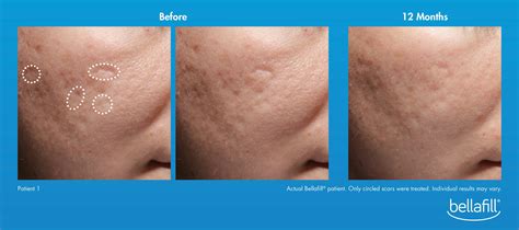 Acne Scars Forehead Before And After