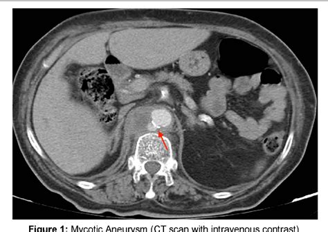 Mycotic Aortic Aneurysm