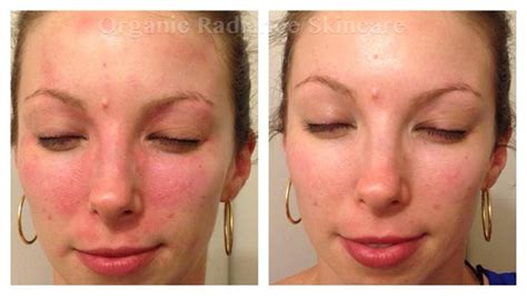 Face Moisturizer Allergic Reactions At Walter Gallup Blog