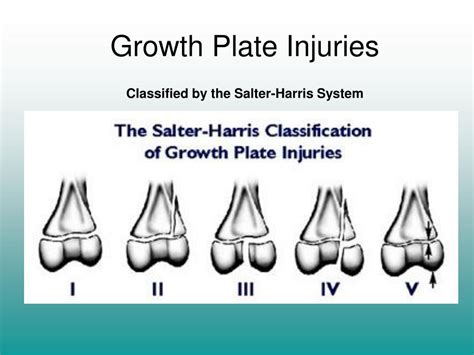 Ppt Growth Plate Injuries Powerpoint Presentation Free Download Id