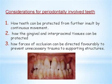 Guideplane Rpd Swinglock Rpd Removable Partial Overdenture Implant