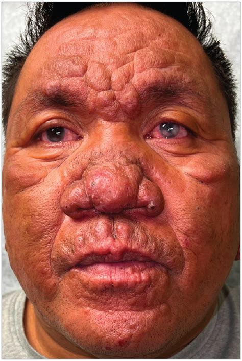 Leonine Facies Of Lepromatous Leprosy Dermatology Jama Dermatology