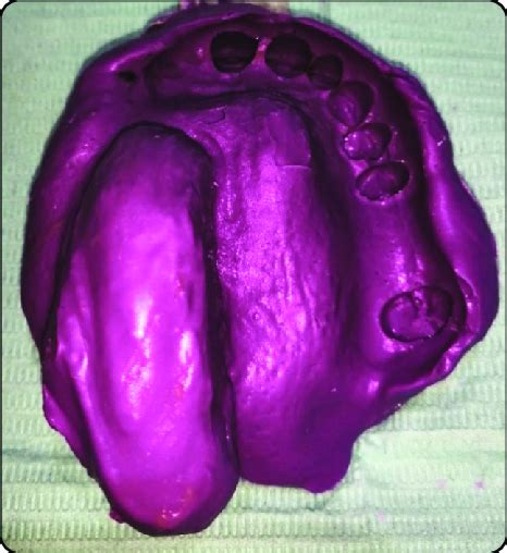 Final Maxillary Impression Download Scientific Diagram