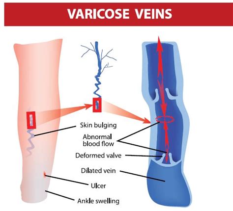 Leaky Valves In Leg Veins At Tami Smith Blog